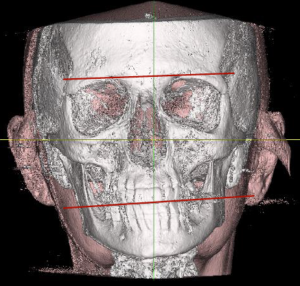 Left Cranial Sidebend/ Rigth Cranial Torsion - FuncPhysio Physical Therapy
