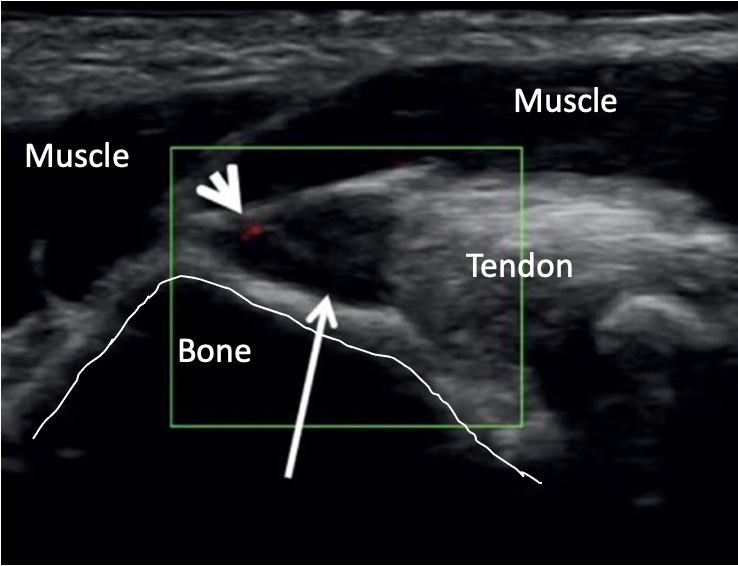 Tennis elbow: Part 1 - FuncPhysio Physical Therapy